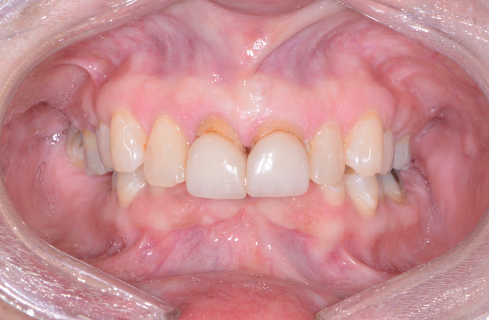 Predictable Immediate Guided Implant Placement and Provisionalization ...