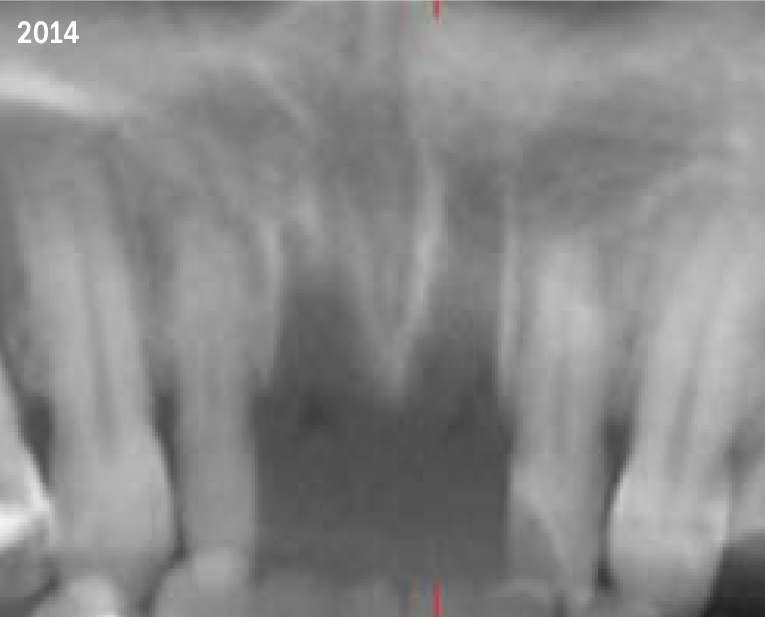 CloseFit RP implants in the esthetic zone