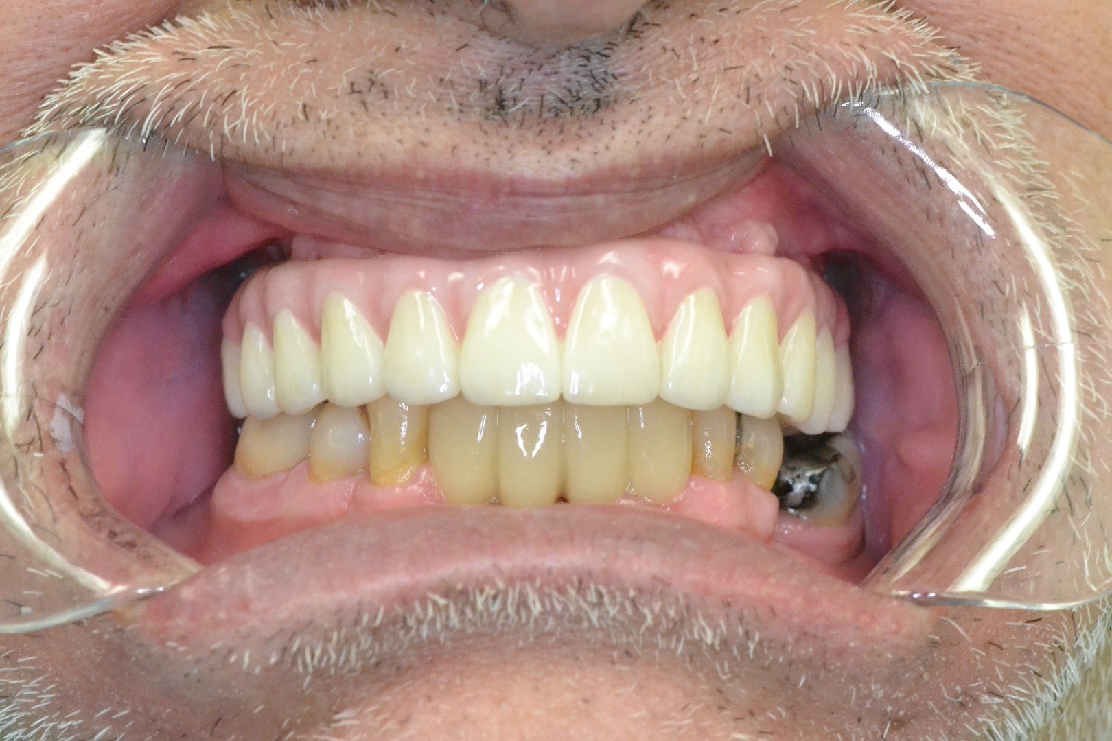 All-on-six with immediate loading of hybrid bridge