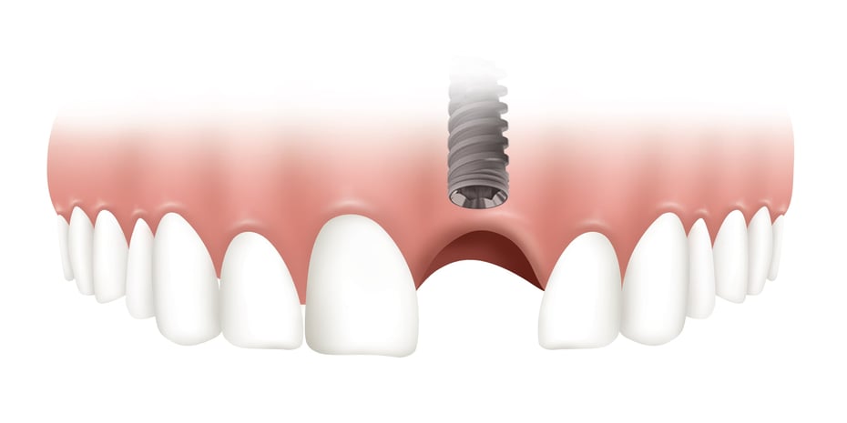 Soft Tissue Management Around Dental Implants and Its Functional ...