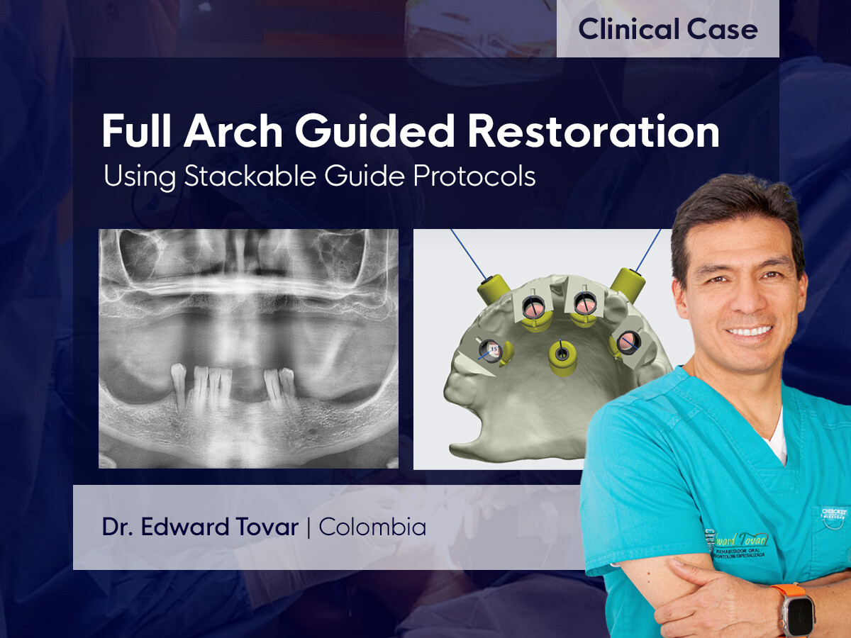 Full Arch Guided Restoration Using Stackable Guide Protocols