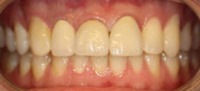 The Dual-Guide Technique