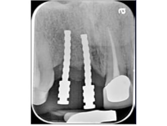 The Dual-Guide Technique