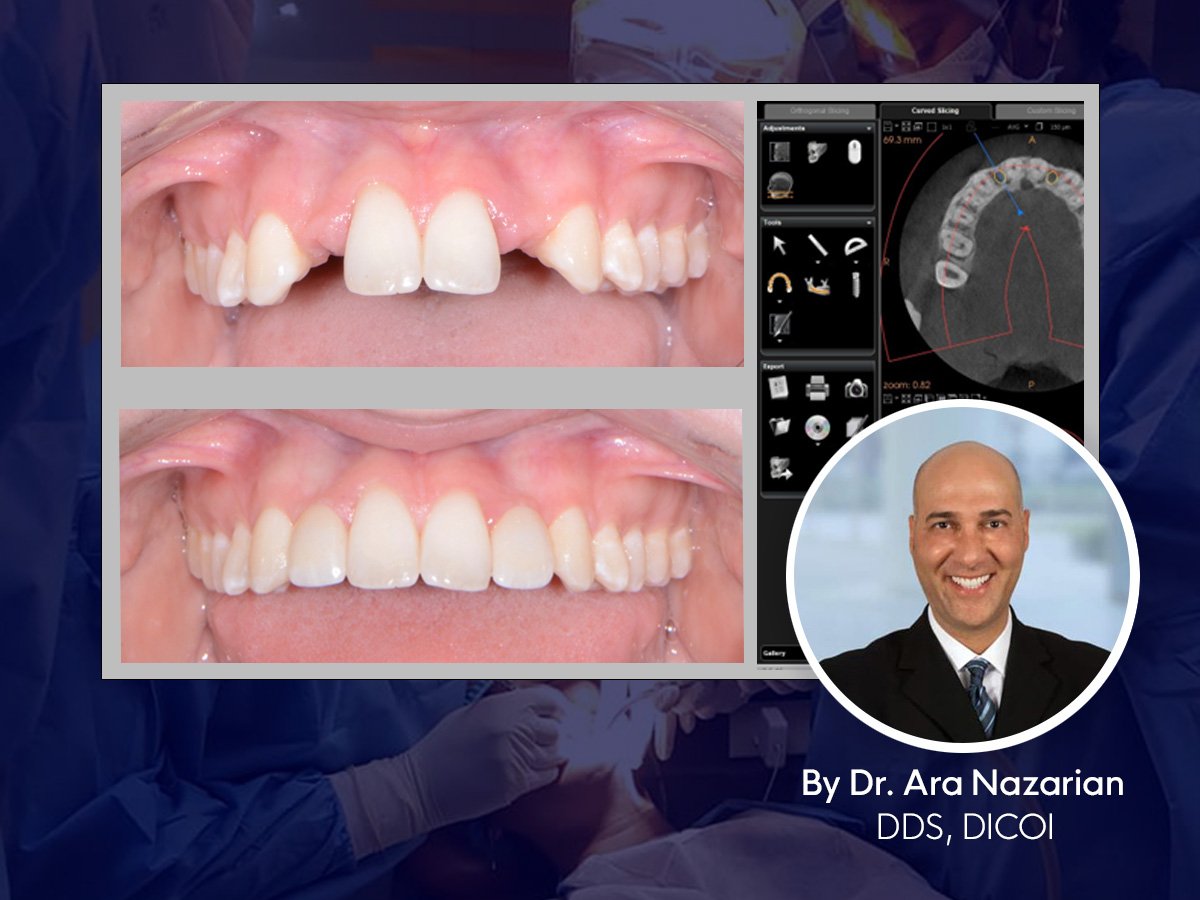 Ultra Narrow Implant Placement for Congenitally Missing Maxillary ...