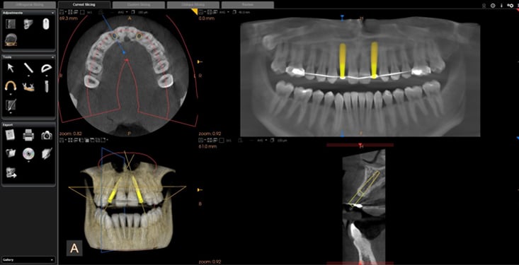Ultra Narrow Implant Placement for Congenitally Missing Maxillary ...