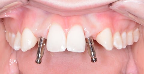 Ultra Narrow Implant Placement for Congenitally Missing Maxillary ...