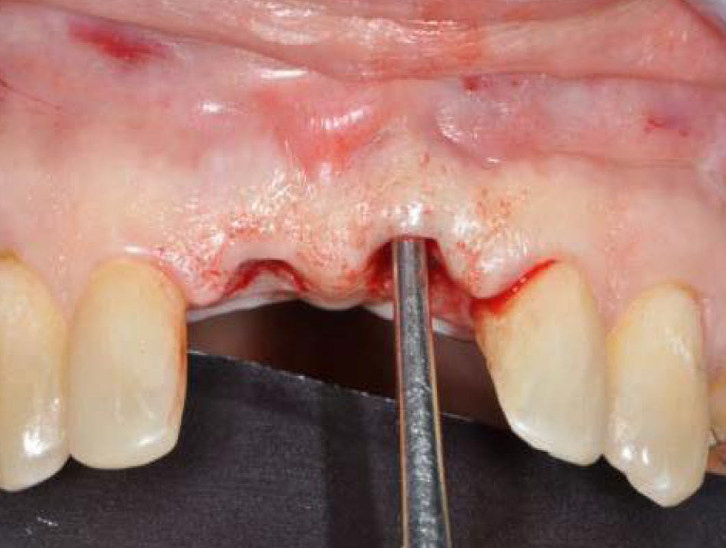 CloseFit RP implants in the esthetic zone