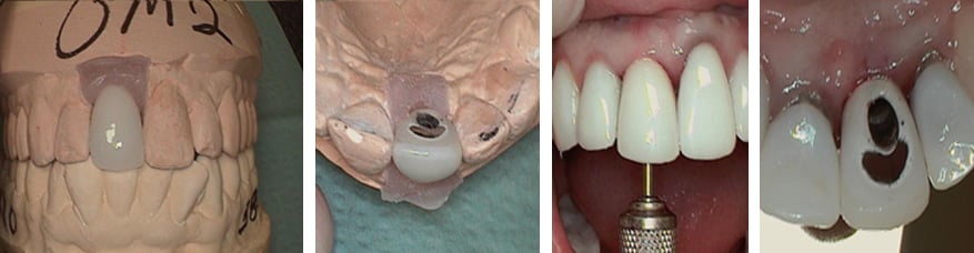 Aesthetic Anterior Implant Restoration: Using Adin guide